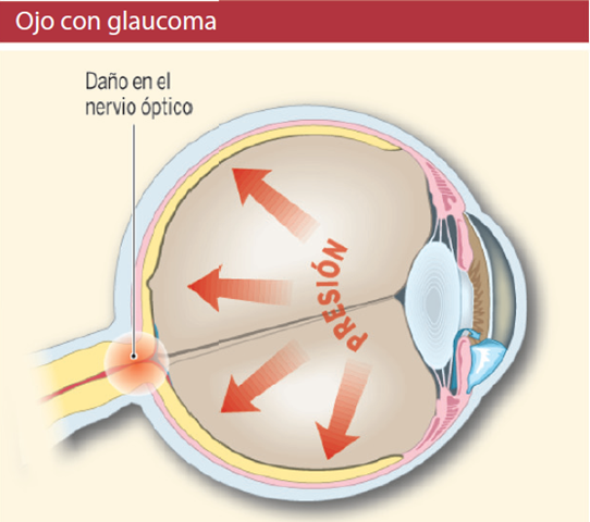 Glaucoma Tension Ocular Ldo